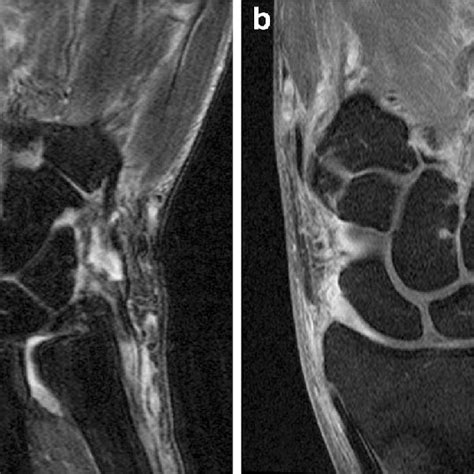 Erosion In The 2nd Mcp Joint From Dorsal Download Scientific Diagram