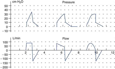Ventilator Graphics Thoracic Key