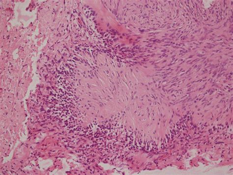 Neuroblastoma Like Schwannoma A Diagnostic Challenge Bmj Case Reports