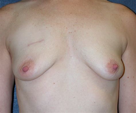 Breast Reconstruction With Ld Flap And Silicone Implants Before And After Results