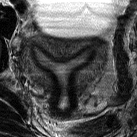 Arcuate Uterus Ultrasound Description