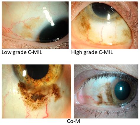 Early Conjunctival Melanoma A Conjunctival Lesion With Irregular