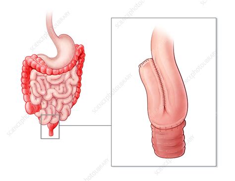 Ileoanal Anastomosis Illustration Stock Image C0277479 Science