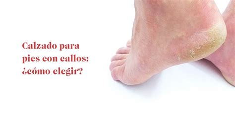 Calzado Para Pies Con Callos ¿cómo Elegir