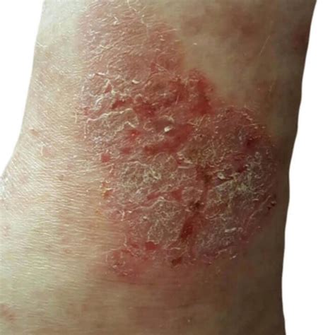 Нервный дерматит 8 фото причины симптомы виды лечение профилактика Лостерин