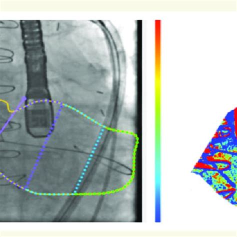A The Velocity Time Integral VTI Of Descending Aortic Diastolic Download Scientific Diagram