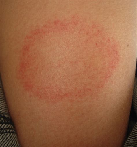 Annular Lesions In Dermatology Annular Erythema Symptoms Dflasj