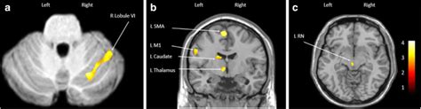 Statistical Parametric Map Of The Average Neural Activity Within The