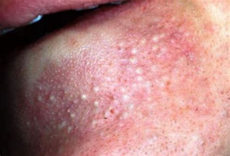 Acne Around Mouth Or Chin Causes And Treatments Skincarederm