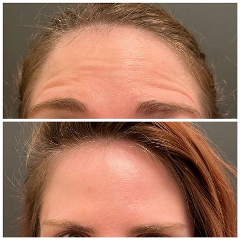 Daxxify Review Daxxify Before And After Photos