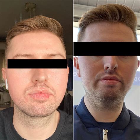 Undefined Cheekbones Making Concave Faces Convex World Renowned