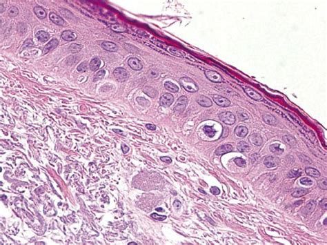 Senile” Keratosis Atrophic Type Of Elastosis In The Dermis Staining Download Scientific