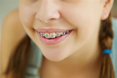 Eating With Caution Top Foods To Avoid When You Have Braces My