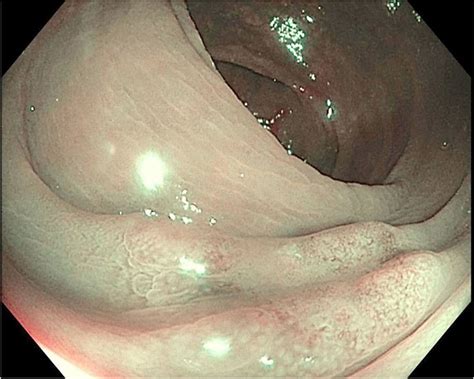 Endoscopic Appearance Of The Colonic Lesion Sessile Polyp With