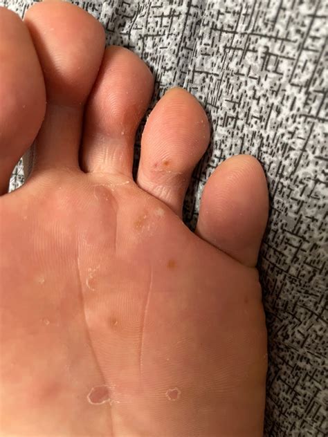 발바닥 물집습진 지식in