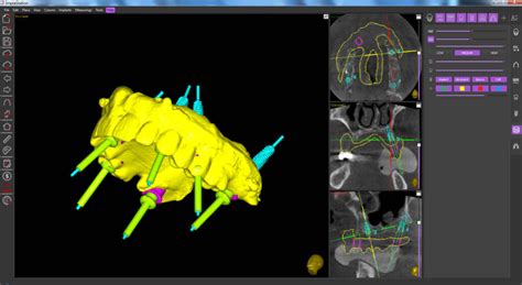 Full Edentulous Jaw Universal Double Scanning Technique Implastation