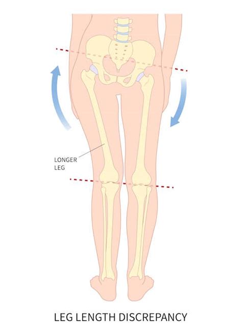 Leg Length Discrepancy In Birmingham Restore Confidence The
