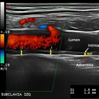 IMT Measurement Intima Media Thickness IMT Is Measured As The Download Scientific Diagram