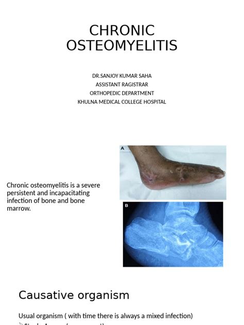 Chronic Osteomyelitis Overview And Treatment Pdf Diseases And
