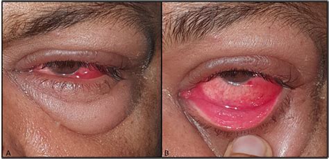 A Case Of Severe Acute Viral Conjunctivitis With Lid Swelling Download Scientific Diagram
