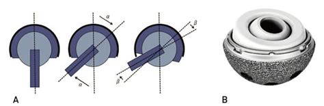 Comparison Of Constrained Acetabular Components And Dual Mobility Cups