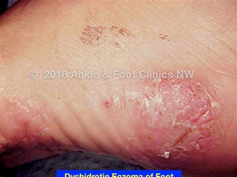 Dyshidrotic Eczema Dyshidrotic Eczema Overview Causes Diagnosis