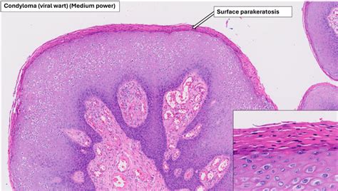 Perianal Warts Pathology Outlines