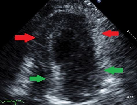 Echocardiography Shows The Left Ventricle In Systolic Phase Revealing