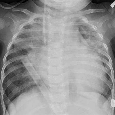 pulmonary chest x ray abnormalities kaggle