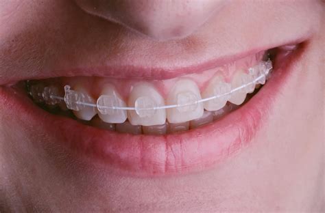 What Are Clear Braces And How Do They Work Debrabernier