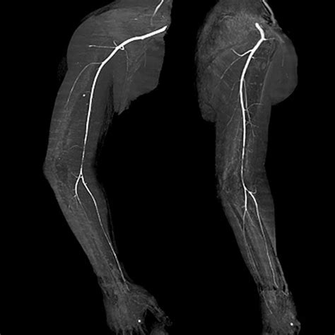 Upper Extremity Arterial Disease In Bay Area Ca