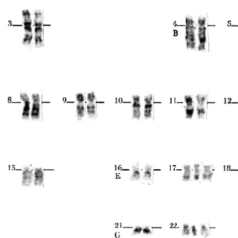 A Case Of Simple Adenoma Sa With Thyroiditis Showing A Hyperdiploid