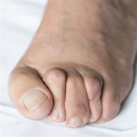 How To Treat A Toe Deformity Solon Podiatrist