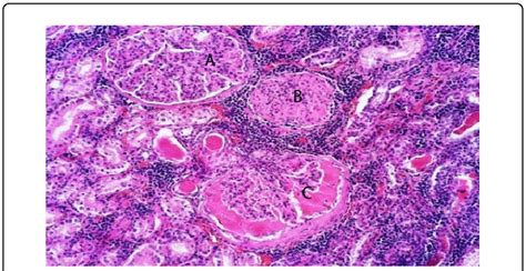 Three Glomeruli Showing Different Lesions A Periglomerular Fibrosis Download Scientific