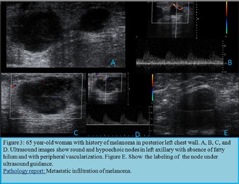 Figure 3 From Suspicious Lymph Nodes Metastasis Of Malignant Cutaneous
