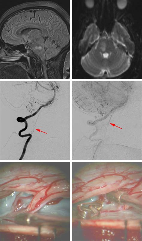 Spinal Av Fistula Disconnection The Neurosurgical Atlas
