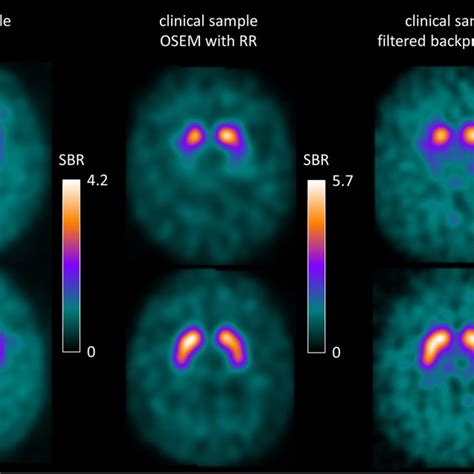 Representative Fp Cit Spect Images The Left Column Shows A Patient Download Scientific Diagram
