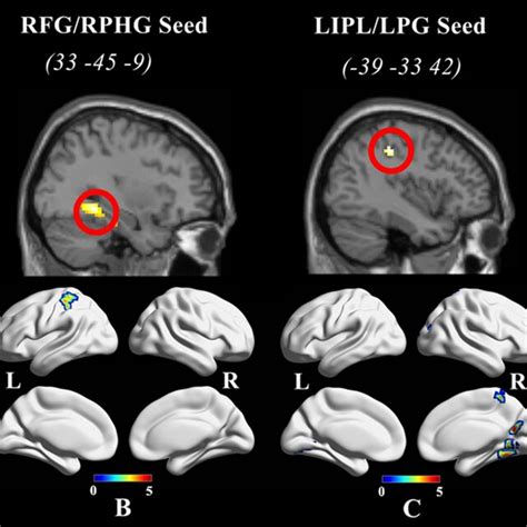 Significant Increases In Seed Based Functional Connectivity In