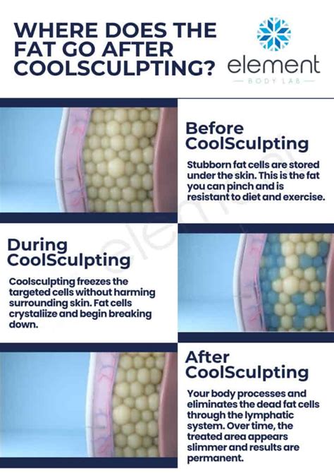 Fat Freezing Treatment Trends In Non Surgical Fat Loss