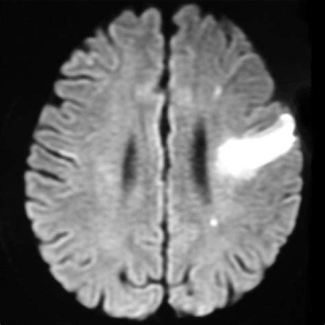 Axial Diffusion Weighted Imaging Showing The Acute Infarctions In The Download Scientific