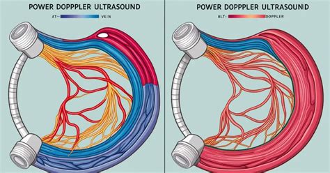 Power Doppler Vs Color Doppler When To Use Each In Ultrasound