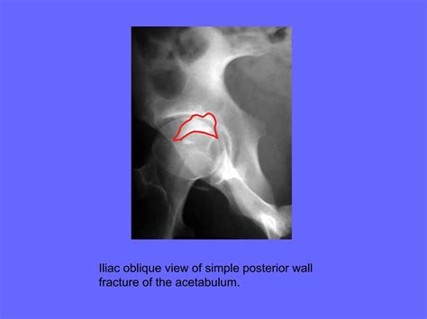 Fractures Of Acetabulum Ppt Fractures Around Hip Ppt