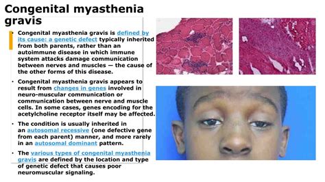 Ppt Myasthenia Gravis Powerpoint Presentation Free Download Id
