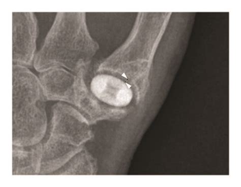 Postoperative Radiographic Measurements A Proximal Migration Of The