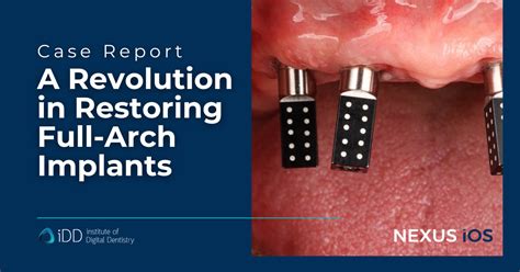 The Nexus IOS Workflow Restoring Full Arch Implants