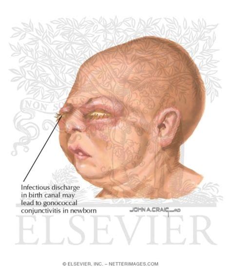 Gonococcal Ophthalmia