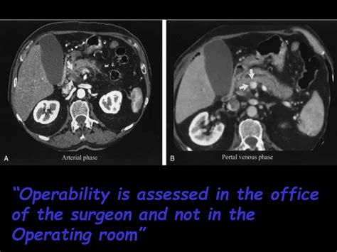 Periampullary Carcinoma Ppt Pptx Download Pptx