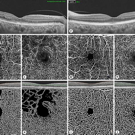 Correlation Of Vessel Density Vd Of The Superficial Capillary Plexus