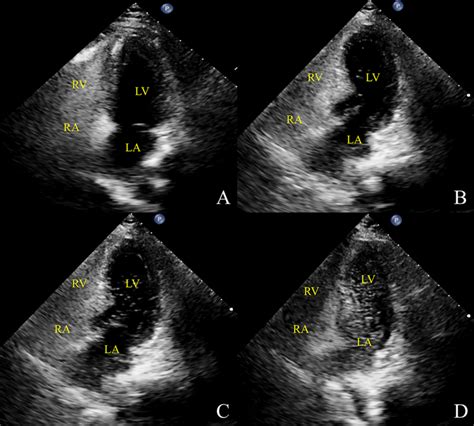 Quantification Of RLS By C TTE No RLS A Mild RLS B Moderate RLS Download Scientific