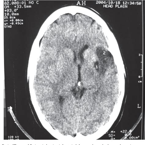 Operculum Brain Of The L